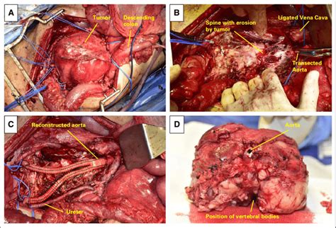 Surgical Resection Of Retroperitoneal Sarcoma A Retroperitoneal Download Scientific Diagram