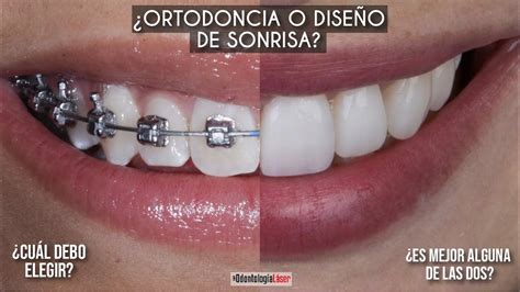 Ortodoncia o Diseño de sonrisa Cuál es mejor Odontología