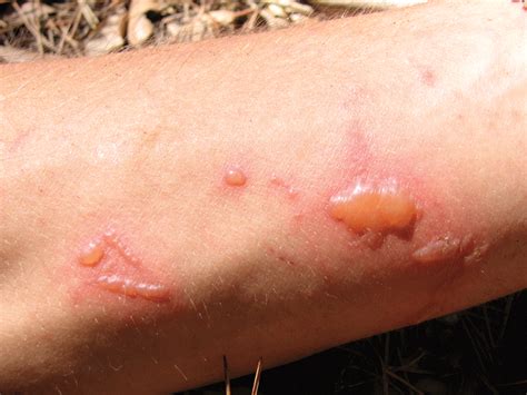 Phytodermatitis A Brief Review Of Human Skin Reactions Caused By The