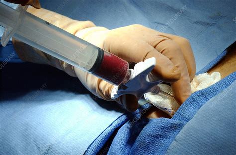 Bone Marrow Biopsy Stock Image C0435969 Science Photo Library
