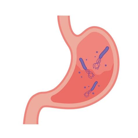 헬리코박터 파일로리 감염 대장암과도 연관있어 네이트 뉴스