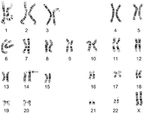 Translocation Down Syndrome Karyotype
