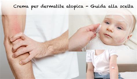 Crema para la dermatitis atópica Cuál es la más efectiva