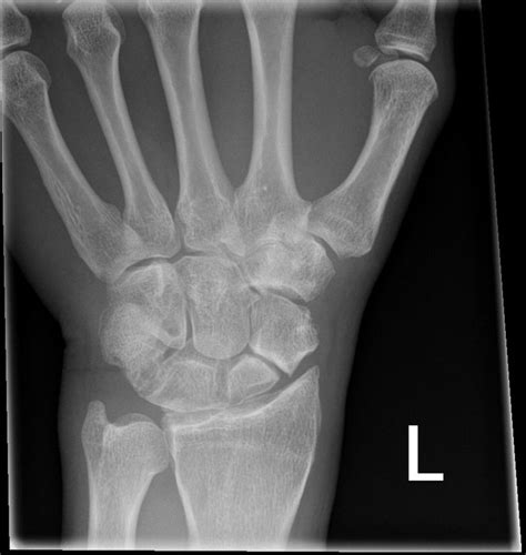 Bipartite Scaphoid Controversy Whether This Condition Is Congenital