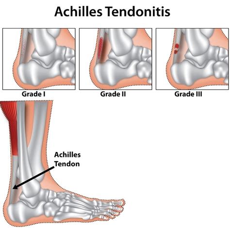 Achilles Tendinitis Causes Symptoms And Treatments SportNova UK