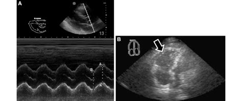 A Left A Sample Transthoracic Echocardiographic View Demonstrating A