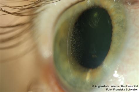 Anterior Uveitis