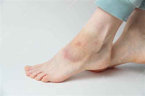 Premium Photo Sprained Ankle With Bruise And Swelling On A Female