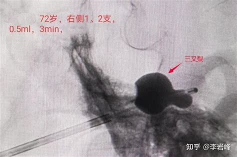小球囊解决大问题三叉神经痛病例分享 知乎