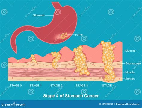 Gastric Cancer Stomach Tumor In The Digestive System Cartoon Vector