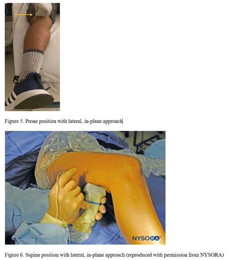 Popliteal Sciatic Nerve Block Em Ultrasound Section