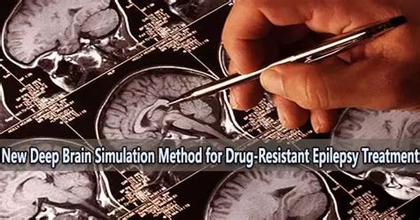 New Deep Brain Simulation Method For Drug Resistant Epilepsy Treatment Assignment Point
