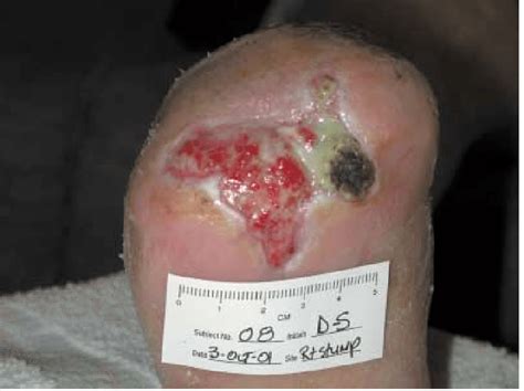 Amputation Stump With Necrotic Yellow Fibrinous And Granulation Tissue Download Scientific