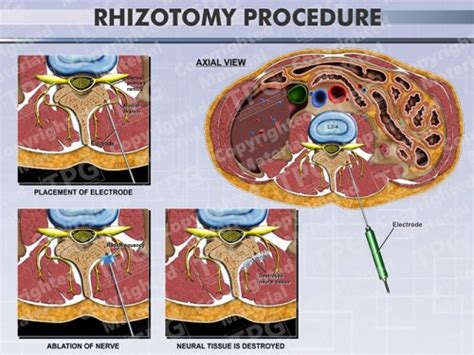 Nerve Block Procedures Order