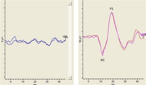 Update On Cvemp And Ovemp Testing In Superior Canal Dehiscence