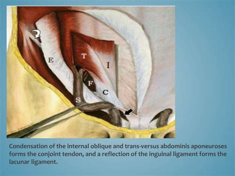 Ultrasoud Hernia Pptx