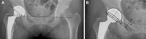 Radiographic Cup Inclination A And Anteversion B Were Measured On