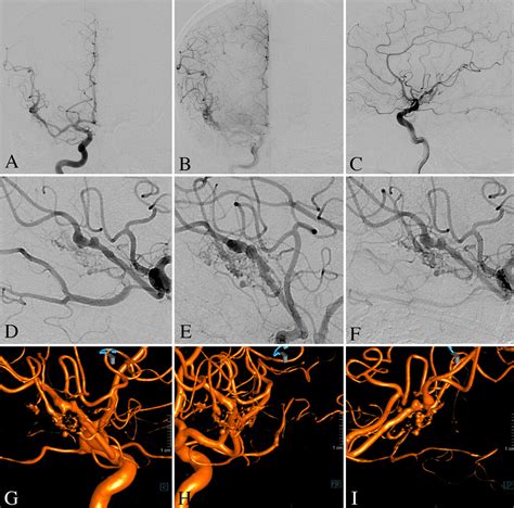 Endovascular Treatment Of A Ruptured Pure Arterial Malformation And Associated Dysplastic Middle