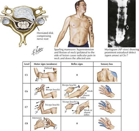 Cervical Radiculopathy Neupsy Key