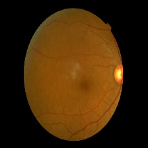 Detection Of Diabetic Retinopathy Using Machine Learning Classification
