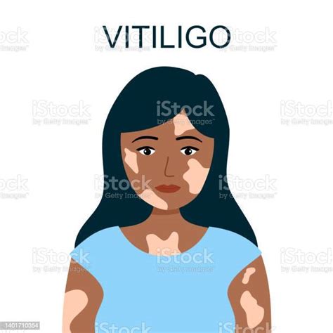 Vitiligo 피부질환 컨셉 벡터 일러스트레이션 피부 문제가있는 여성 백반증에 대한 스톡 벡터 아트 및 기타 이미지 백반증