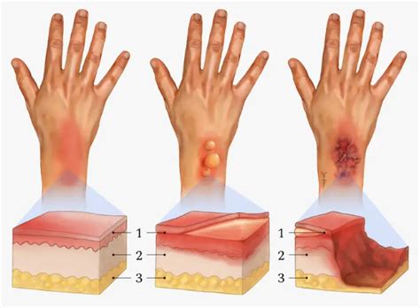 آفتاب سوختگی؛ درمان خانگی و پزشکی 1 مرکز سلامتی