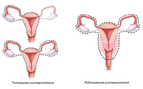 Патология эндометрия: что это такое у женщин, признаки, эхопризнаки ...