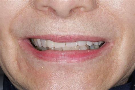 Implantes Dentales Fotos Reales Clinica Unilaser