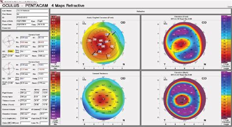 Pre Op Pentacam Zaman Technique Of Blt Type Ii Download Scientific