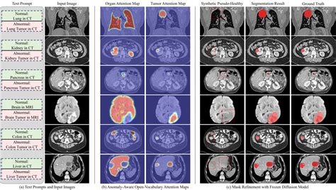 논문 리뷰 Advancing Generalizable Tumor Segmentation With Anomaly Aware Open Vocabulary Attention