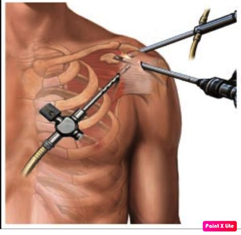 My Shoulder Dislocation And Useful Links And Information On Recovery 🦾