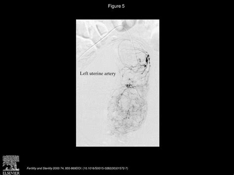 Uterine Artery Embolization For Symptomatic Uterine Myomas Ppt Download