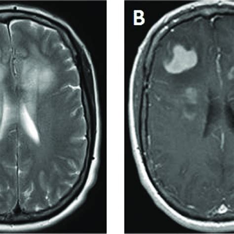 Axial T2 Weighted A And Axial Contrast Enhanced T1 Weighted B Mri