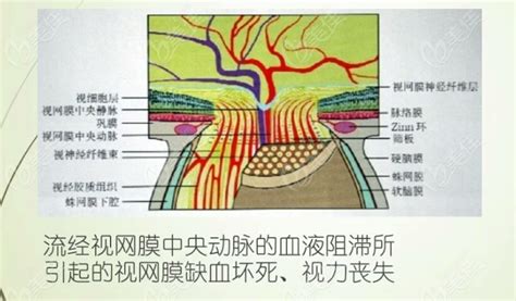 视网膜中央动脉堵塞能治好吗 可以 视网膜中央动脉堵塞治疗方法分享 美佳社区