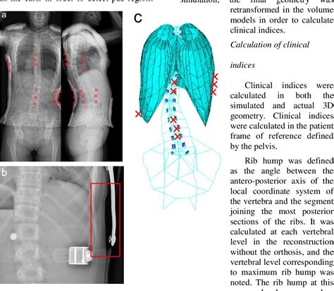 Figure 1 From Evaluation Of A Patient Specific Finite Element Model To Simulate Conservative