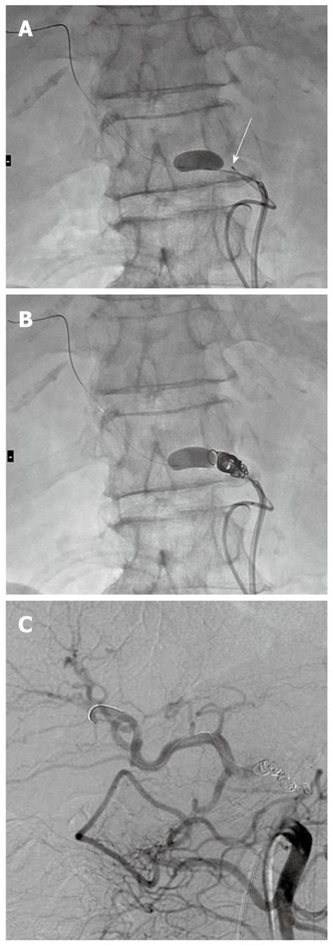 Preoperative Microcoil Embolization Of The Common Hepatic Artery For