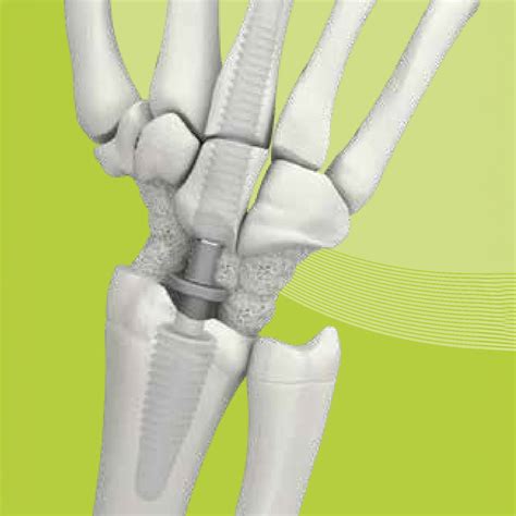Motec Wrist Joint Arthrodesis Medandcare Innovative Solutions