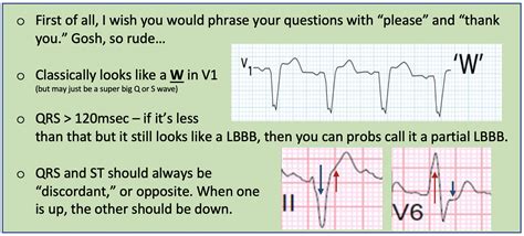 Incomplete Lbbb Criteria