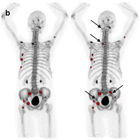 Schematic Of The Ai Model The Lesion Cnn Segments Suspected Metastatic