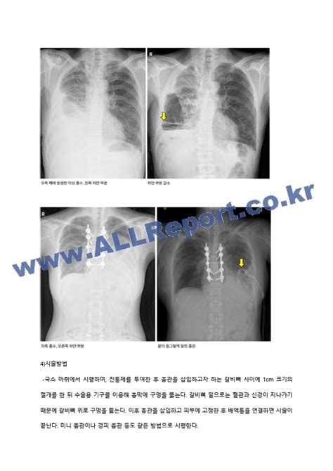 성인간호학실습 케이스스터디 기흉 간호진단 및 간호과정 4개 의약보건레포트