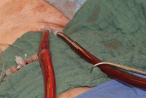 Percutaneous Cannulation Semi Automatic Priming And Automated Air Download Scientific Diagram