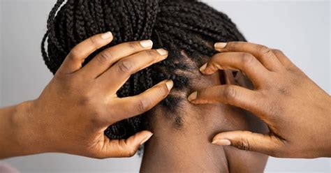 A Dermatologist Told Us Your Flaky Scalp May Not Be Dandruff POPSUGAR Australia