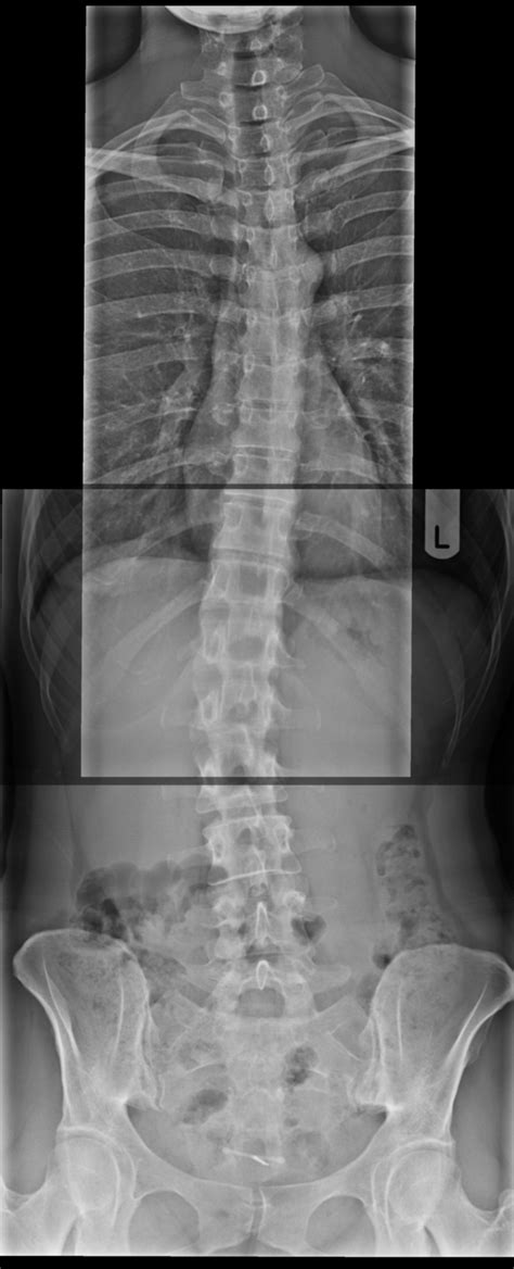 Lumbar Scoliosis Causes Symptoms Andtreatment Options