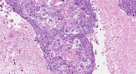Brain Archives Ottawa Atlas Of Pathology
