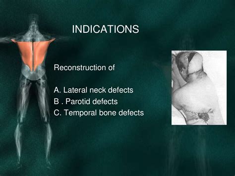 Latissimus Dorsi Flap For Reconstruction In Head And Neck Deffects