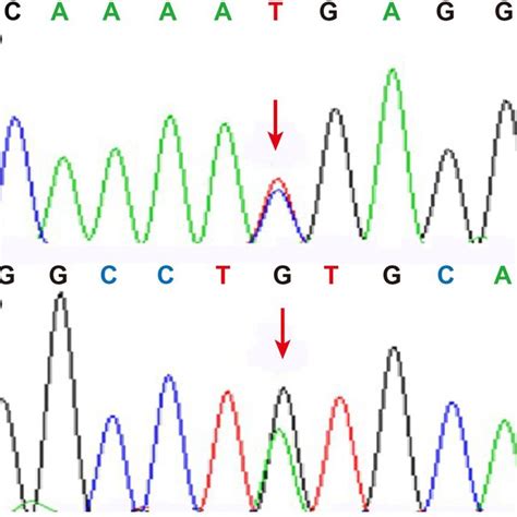 Sanger Sequencing Result Of The Mutation Of Aldh7a1 In Case 1 A A