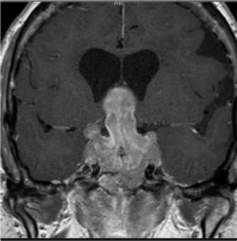 Coronal And Sagittal Contrast Enhanced T1 Weighted Magnetic Resonance