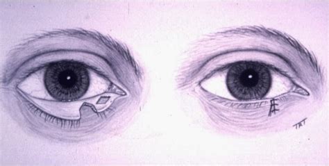 Eyelid Surgery by Prof Dr CN CHUA 蔡鐘能 A Severe Case of Out turning of the Lower Eyelid