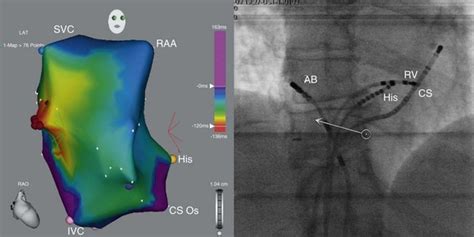 Atrial Tachycardia Thoracic Key