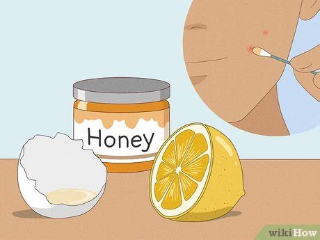 Ways To Get Rid Of A Hard Pimple WikiHow